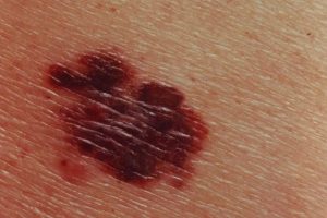 10 Deadly Signs of Skin Cancer You Need to Spot Early – Health & Human ...