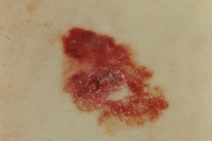 10 Deadly Signs of Skin Cancer You Need to Spot Early – Health & Human ...
